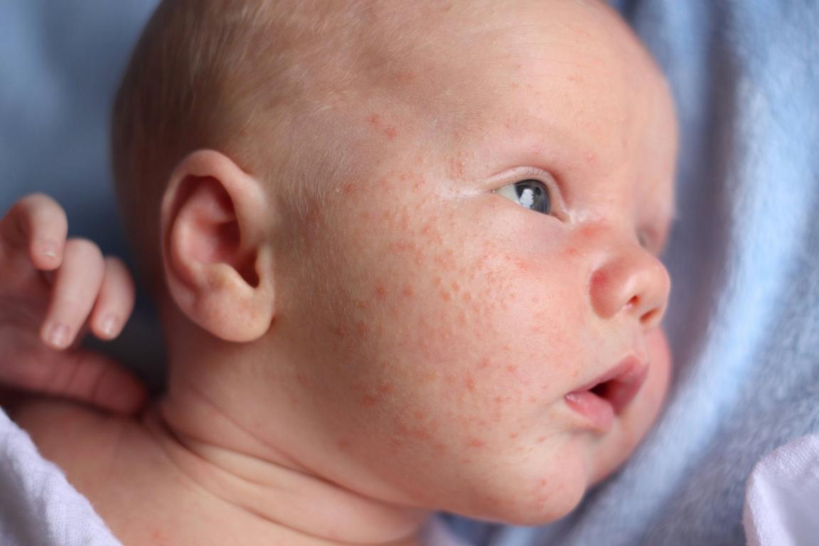 Newborn Rashes and Skin Conditions - Boots Health Hub | Boots