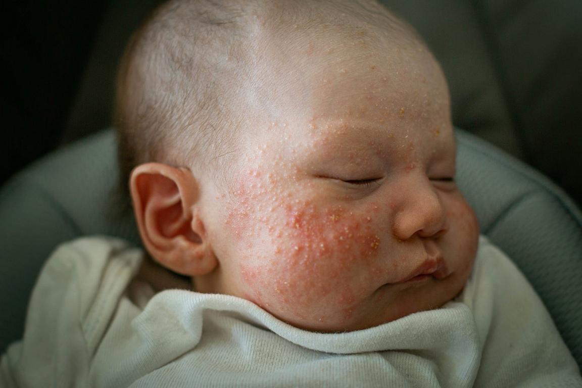 Newborn Rashes and Skin Conditions - Boots Health Hub | Boots