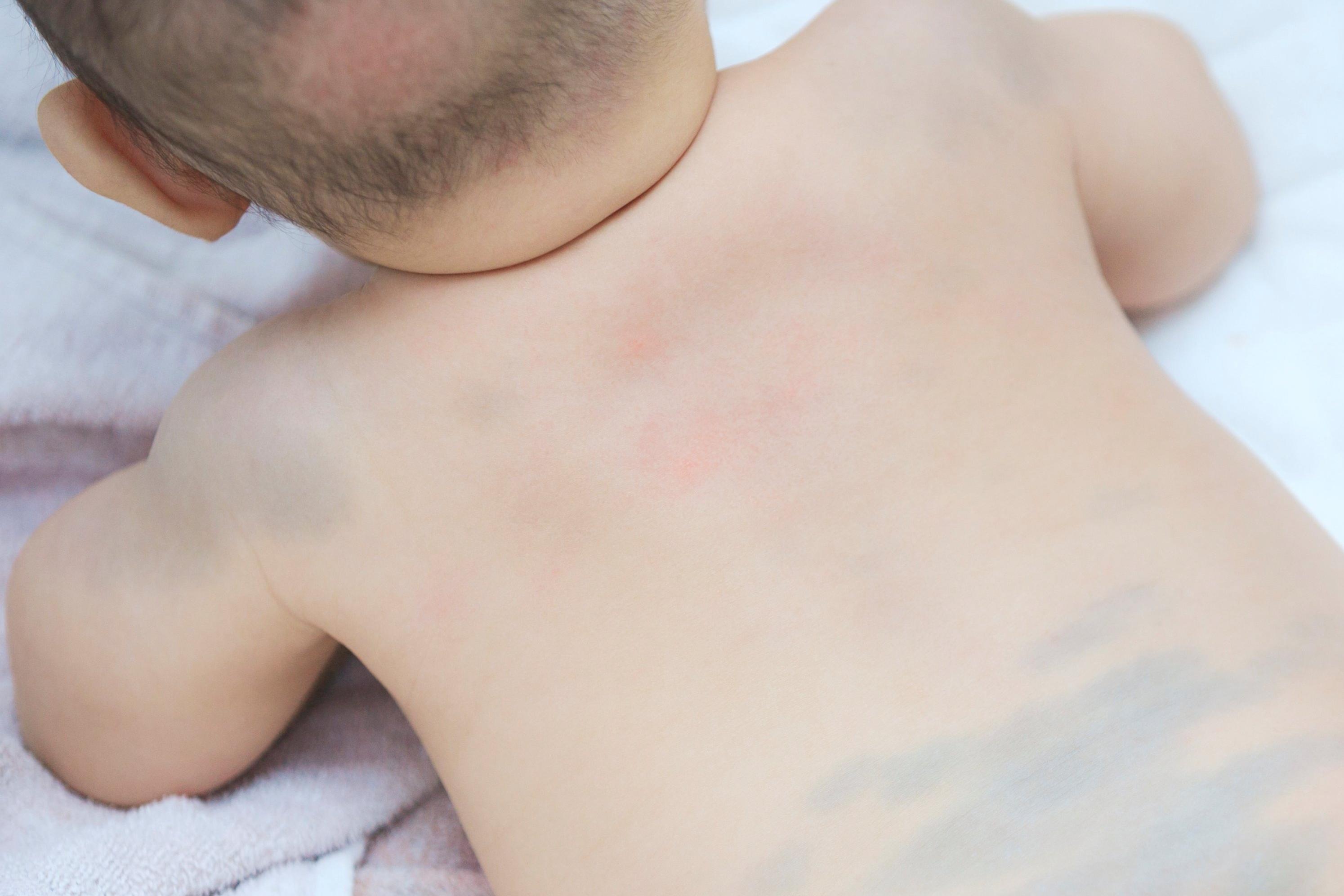 Newborn Rashes and Skin Conditions - Boots Health Hub | Boots