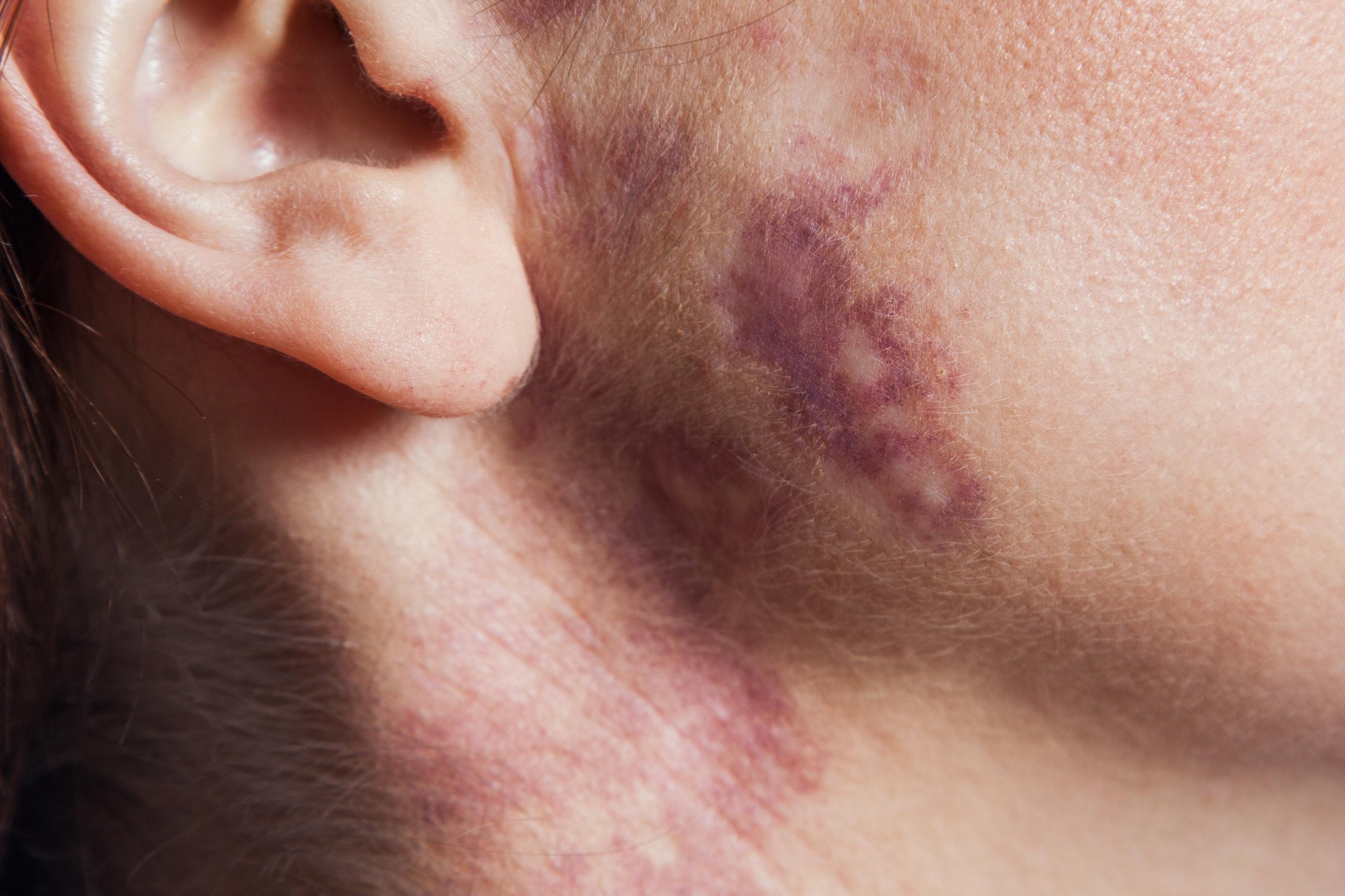 Newborn Rashes and Skin Conditions - Boots Health Hub | Boots