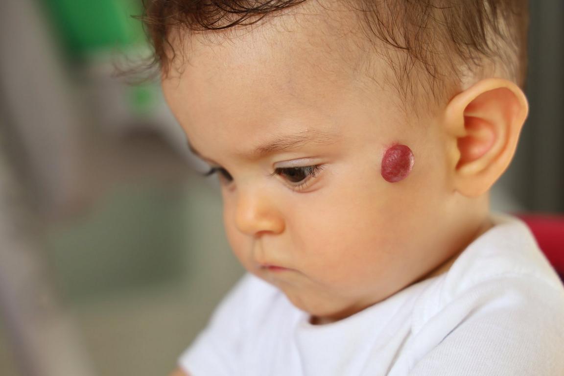 Newborn Rashes and Skin Conditions - Boots Health Hub | Boots