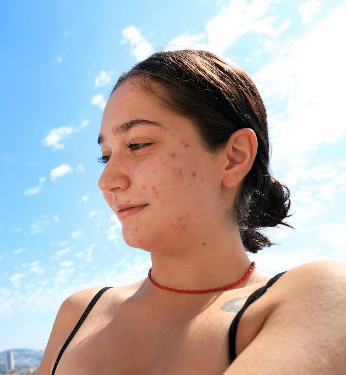 Acnecide - Boots | Boots