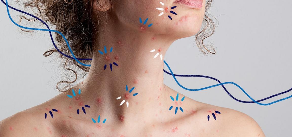 Skin Conditions Services & Advice - Boots Health Hub | Boots
