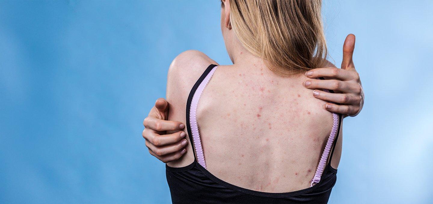 Back acne vs. folliculitis: symptoms and treatments | Boots