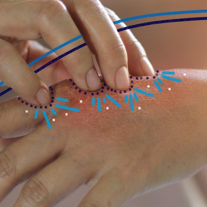 Understanding and Managing Hives - Boots Health Hub | Boots