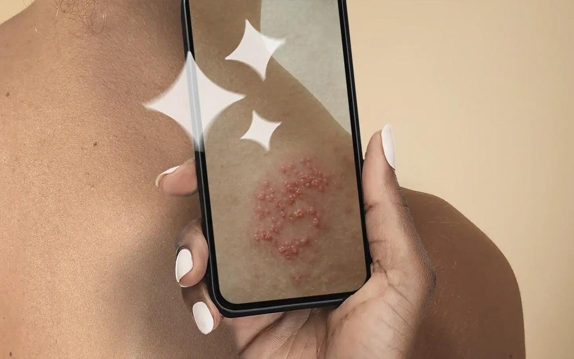 What is rosacea and what causes it? - Boots Health Hub | Boots