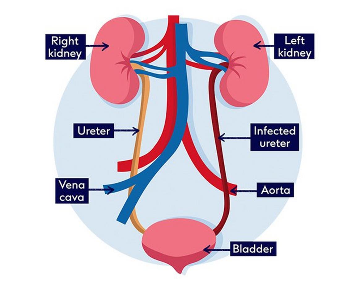 What is cystitis & how to treat it? - Boots Health Hub | Boots