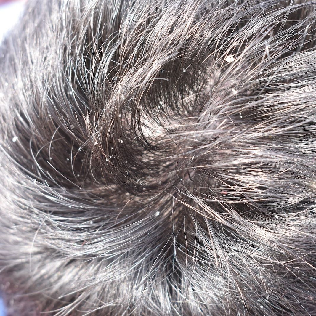 Dandruff Advice and Treatment - Boots Health Hub | Boots