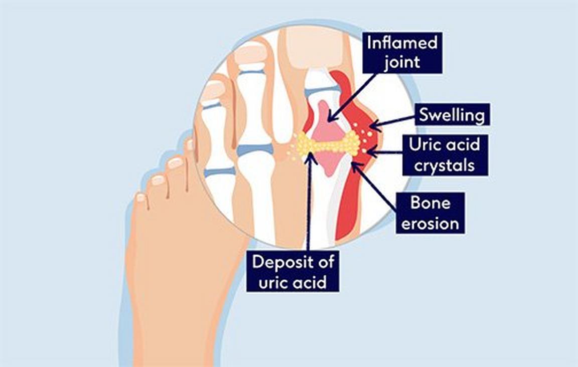 What is gout? | Boots