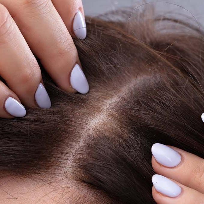 Dandruff Advice and Treatment - Boots Health Hub | Boots