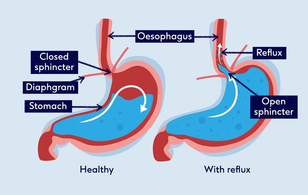 Soothe the sizzle: tips for managing acid reflux & heartburn | Boots
