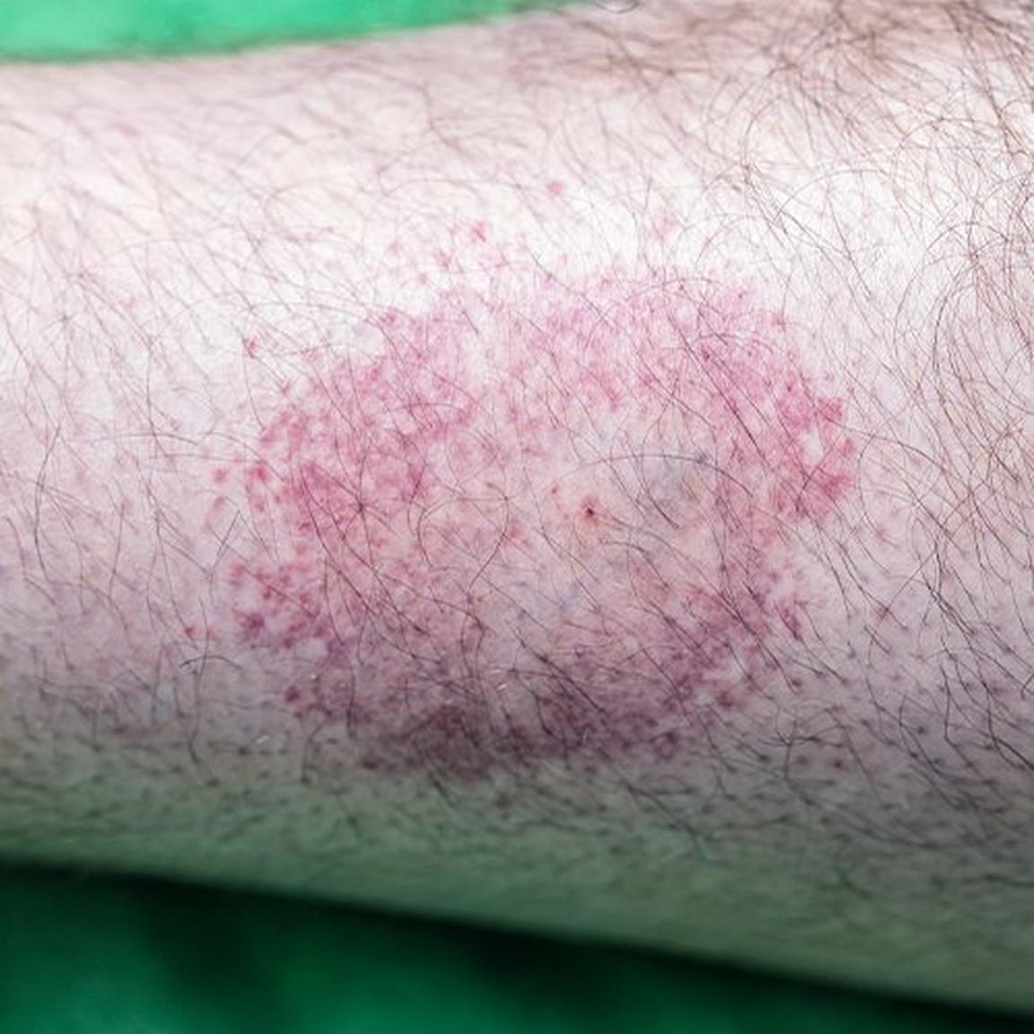 What is Lyme Disease? | Boots