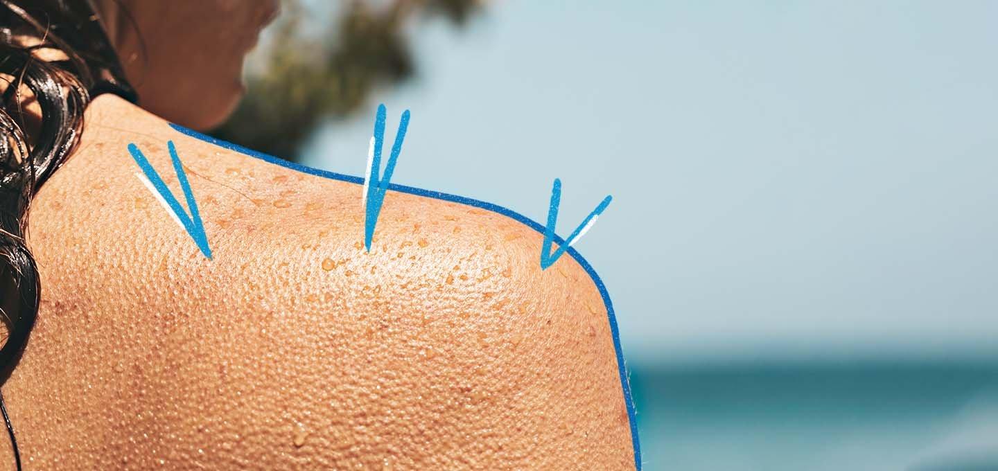 What is heat rash? | Boots