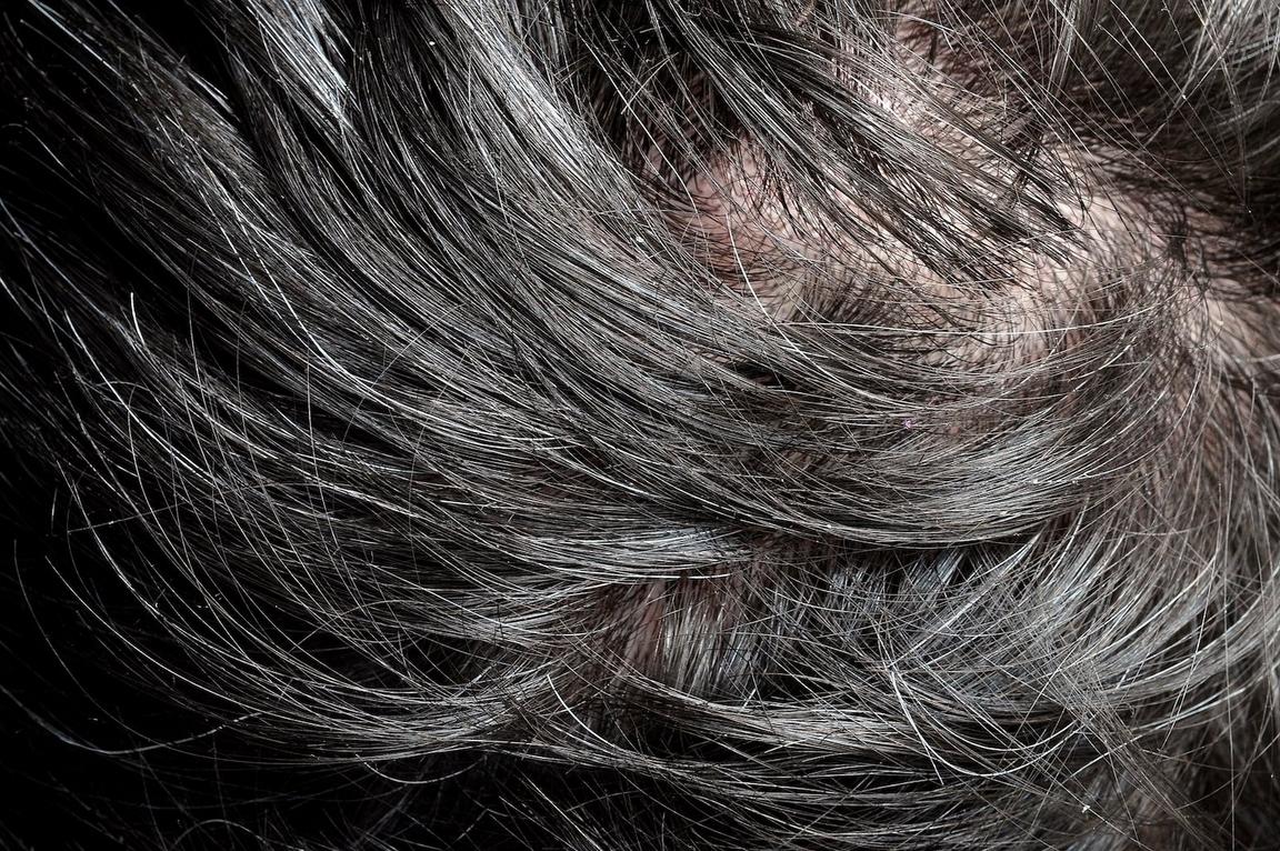 Dandruff Advice and Treatment - Boots Health Hub | Boots