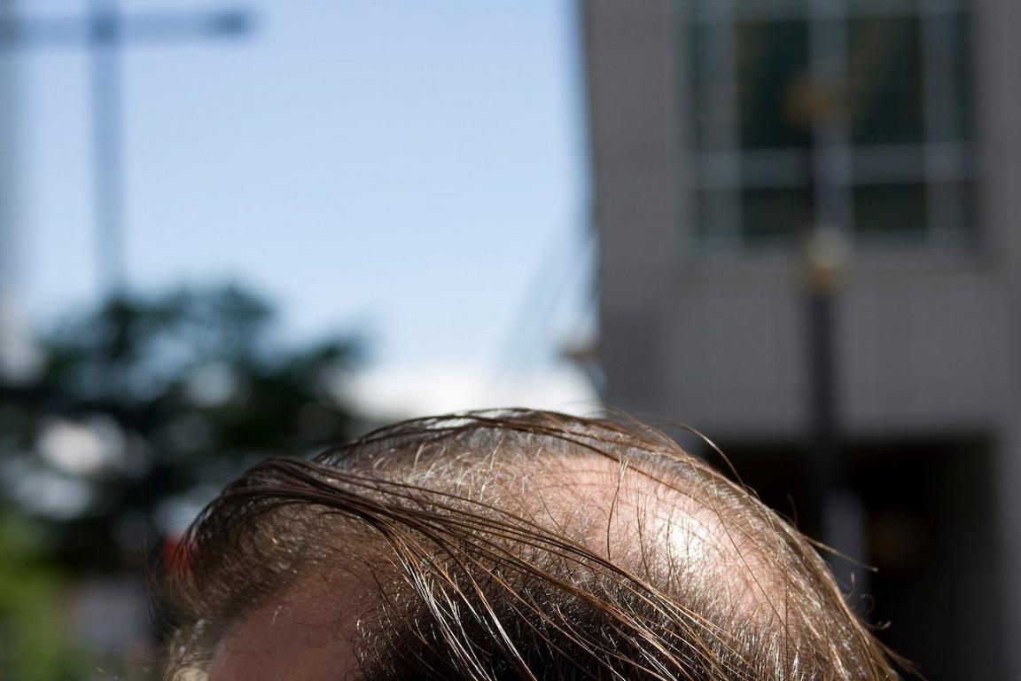 Dandruff Advice and Treatment - Boots Health Hub | Boots