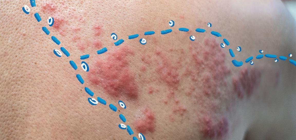 Shingles vaccination side effects: what to expect and how to manage ...