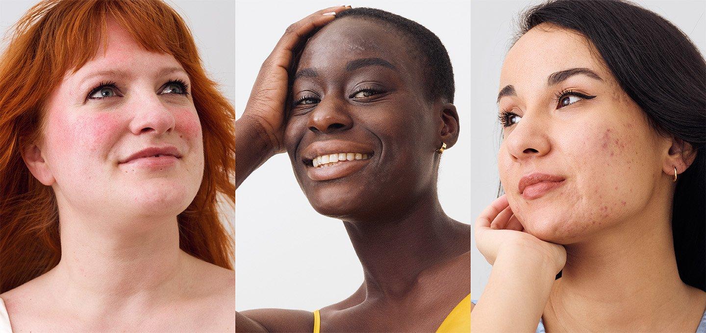 Eczema, Acne & Rosacea: 3 Influencers Talk Skin Positivity | Boots
