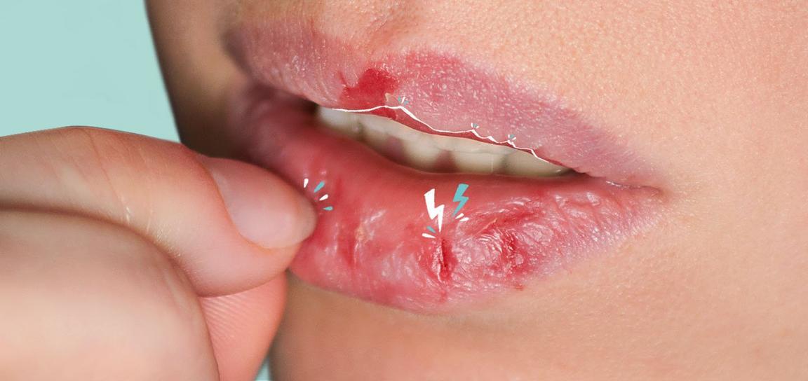 Living with Keratosis pilaris (Chicken Skin) - Boots Health Hub | Boots