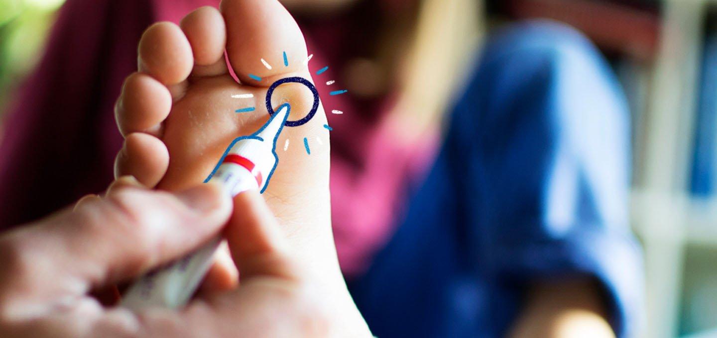 Wart and verruca treatment: your complete guide | Boots